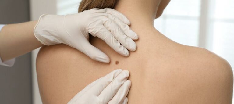 Mole Removal Doctor in Phoenix AZ | Dr. Manish, MD